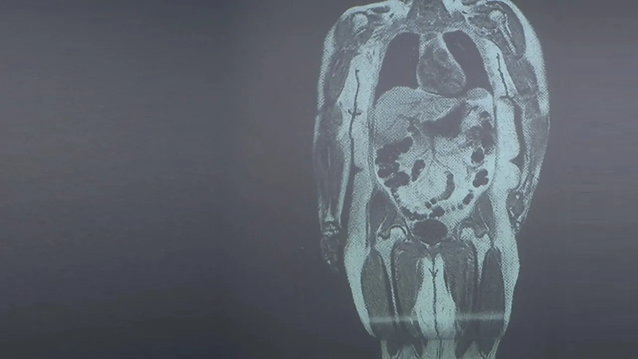 Extrémní obezitou v Česku trpí 150 tisíc lidí. Vznikají specializované ...