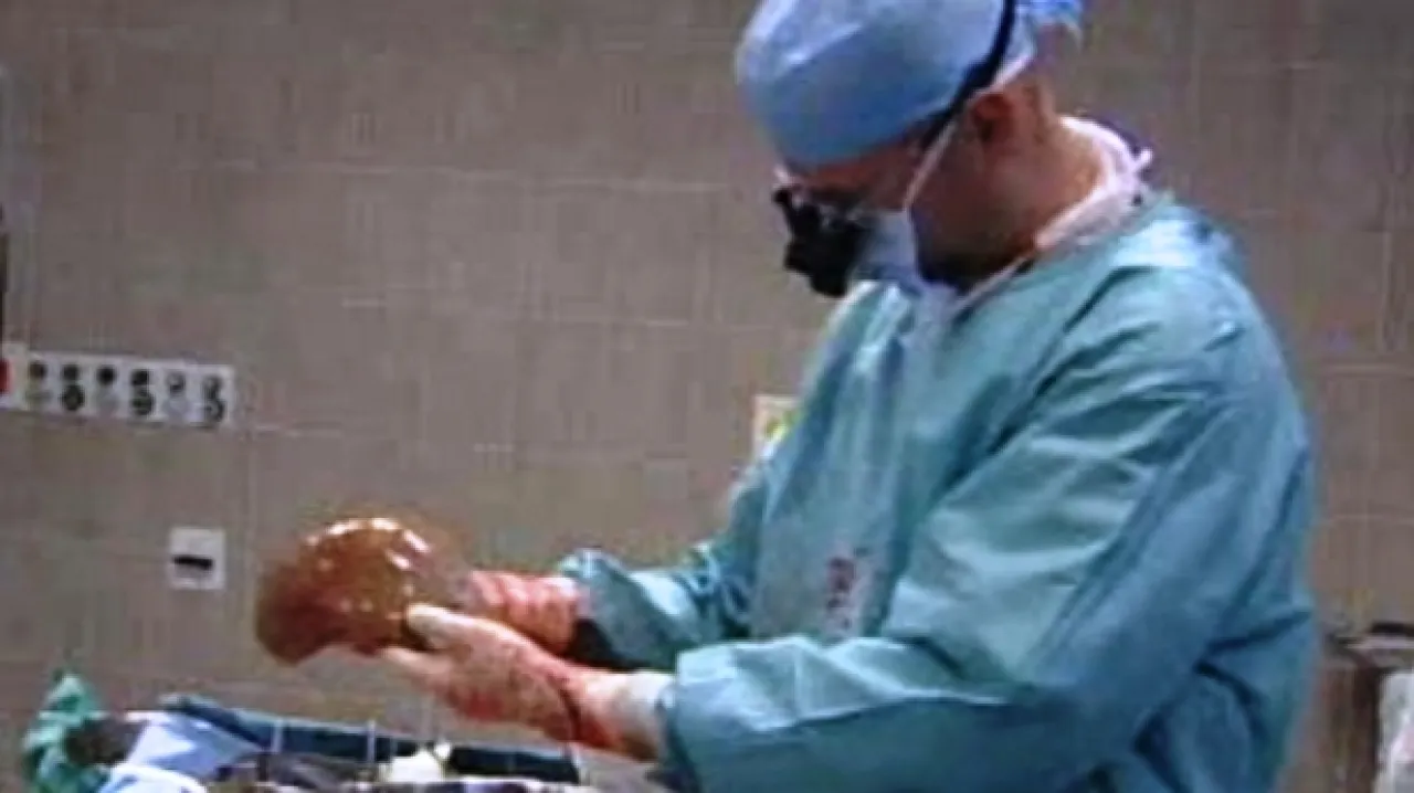 Transplantace jater zatím nemá alternativu — ČT24 — Česká televize