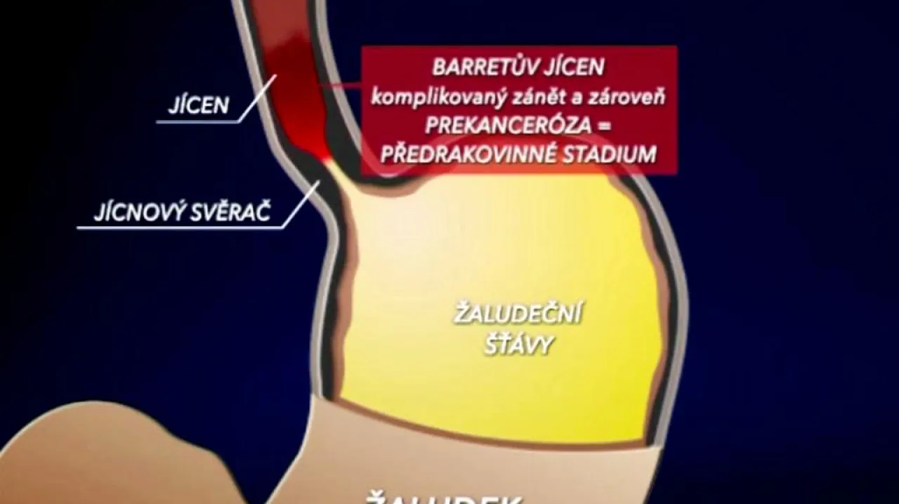 Unikátní vyšetření dokáže předpovědět rakovinu jícnu — ČT24 — Česká ...