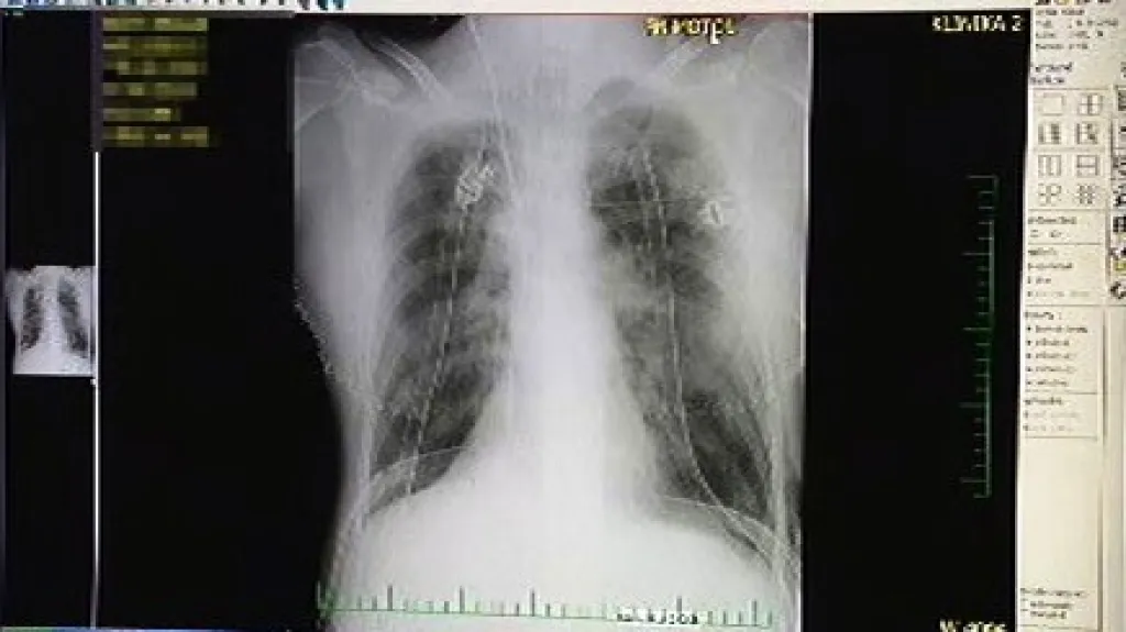 Pojišťovny neumí hradit transplantace plic - chybí kód — ČT24 — Česká ...