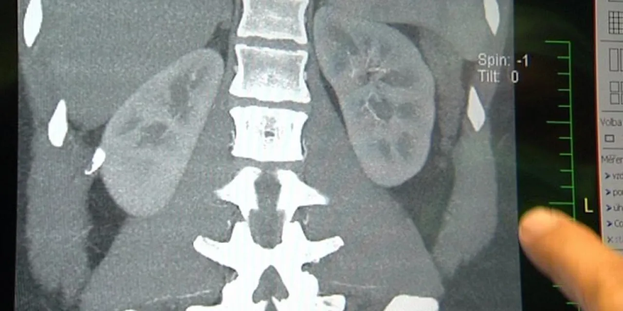 IKEM provedl druhou řetězovou operaci ledvin — ČT24 — Česká televize