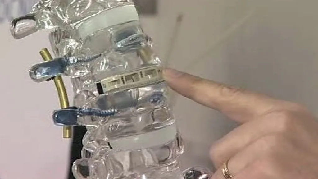 Olomoučtí lékaři operují bederní páteř šetrněji — ČT24 — Česká televize